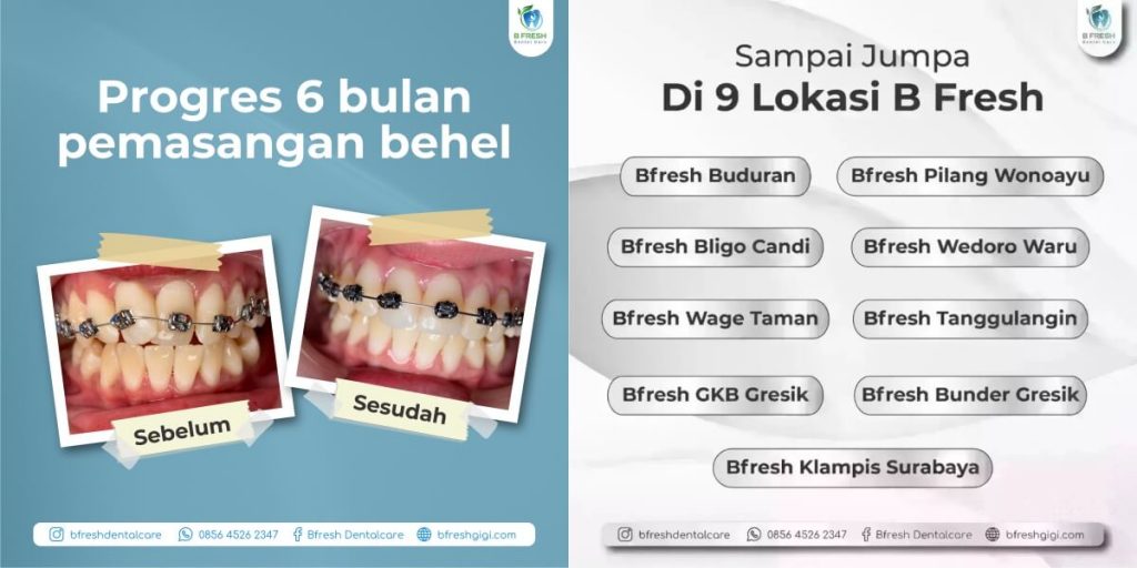 Progress 6 Bulan Pemasangan Behel Gigi - Bfresh Dental Care