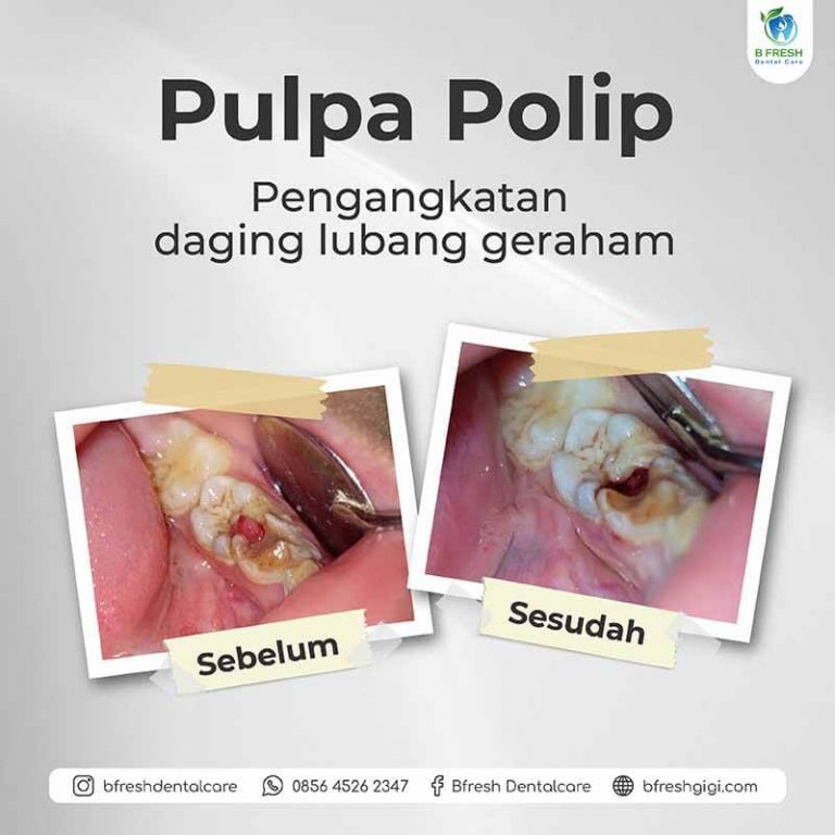 Pulpa Polip - Bfresh Dental Care
