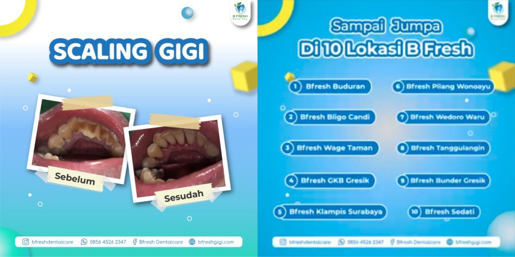 Promo - Bfresh Dental Care