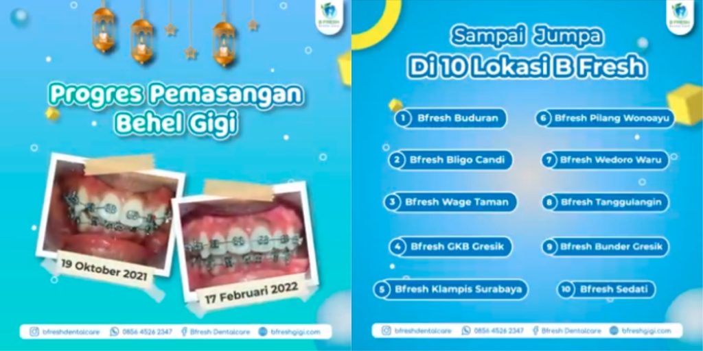 Progress Pemasangan Behel Gigi - Bfresh Dental Care