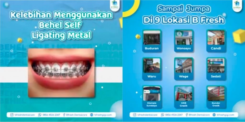 Kelebihan Menggunakan Behel Self Ligating Metal - Bfresh Dental Care
