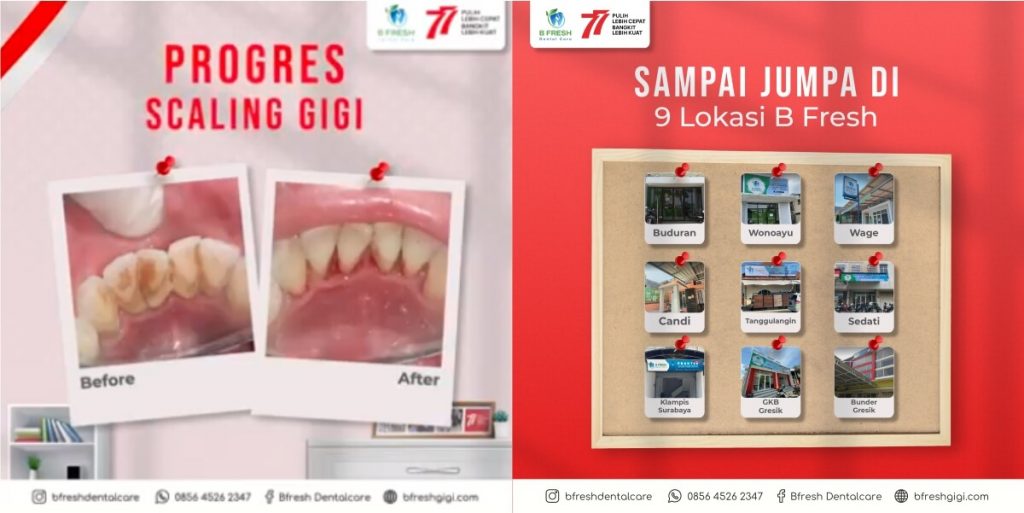 Before After Scaling Gigi - Bfresh Dental Care