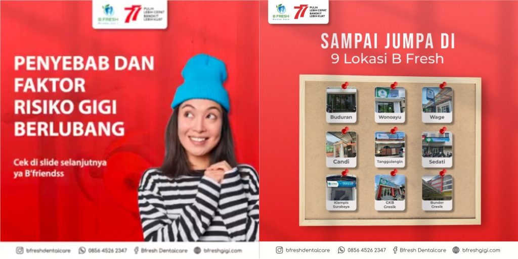 Penyebab Gigi Berlubang - Bfresh Dental Care