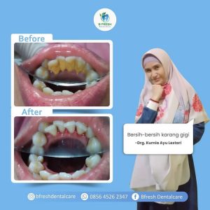 Scaling Gigi - Bfresh Dental Care