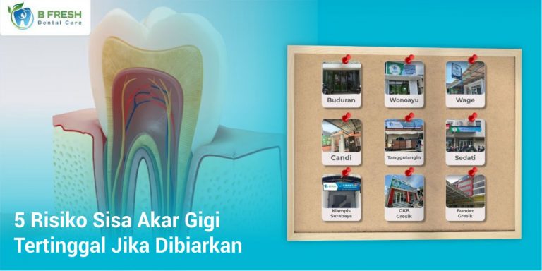 5 Risiko Sisa Akar Gigi Tertinggal Jika Dibiarkan
