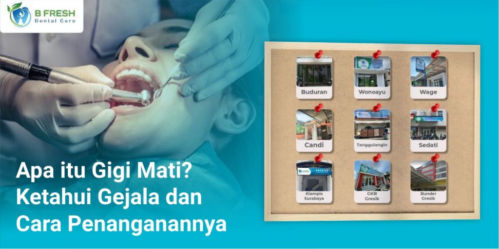Apa itu Gigi Mati? Ketahui Gejala dan Cara Penanganannya