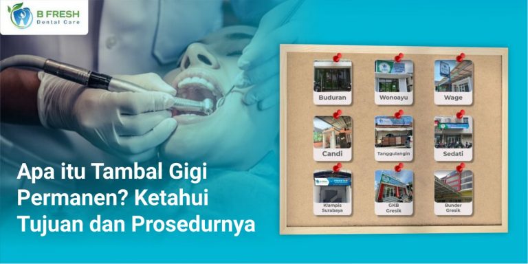 Apa itu Tambal Gigi Permanen? Ketahui Tujuan dan Prosedurnya