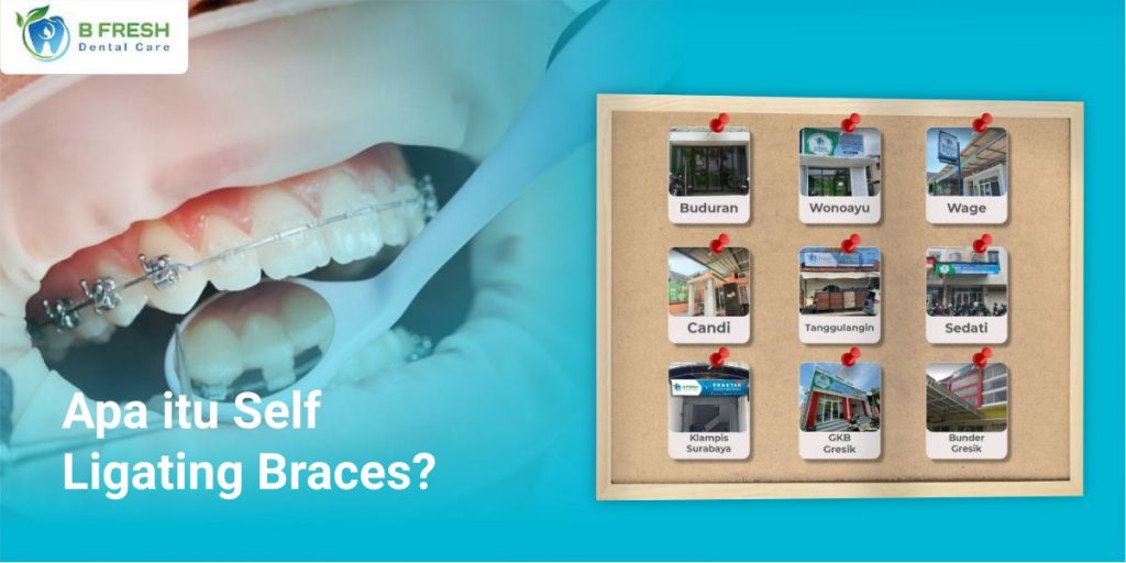 Apa itu Self Ligating Braces? Bedanya dengan Conventional Braces