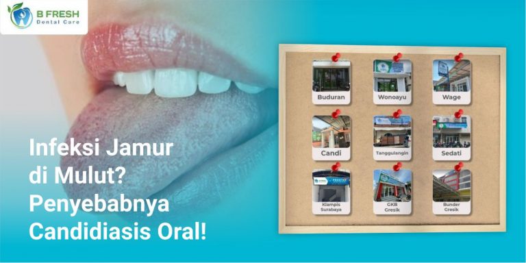Infeksi Jamur di Mulut? Penyebabnya Candidiasis Oral!